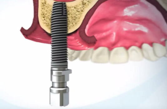 Sinus Lift & Bone Augmentation - AURA DENTAL - Best Dentist/Root Canal ...